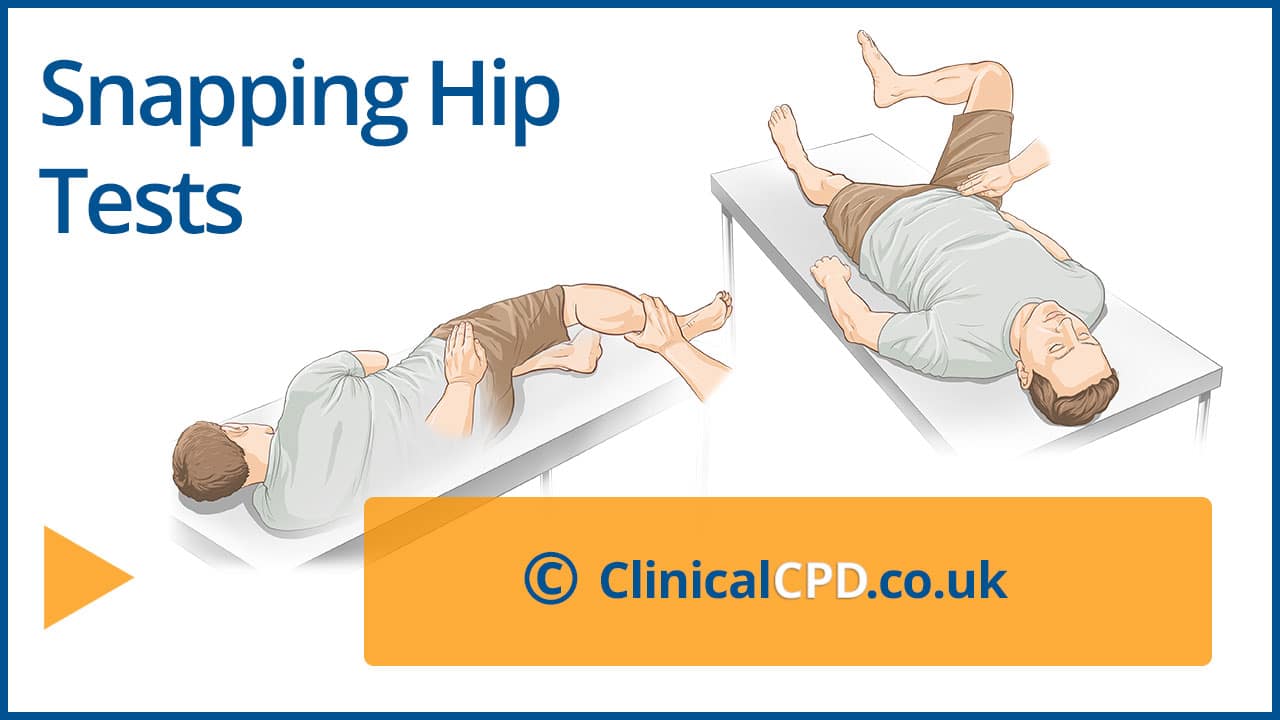 Iliopectineal Eminence Snapping Hip